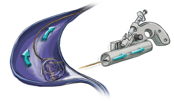 Experience Effective ClariVein® Treatment at La Jolla Vein & Vascular