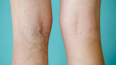 Venous Reflux Disease | Chronic Venous Insufficiency Stages | Venous ...