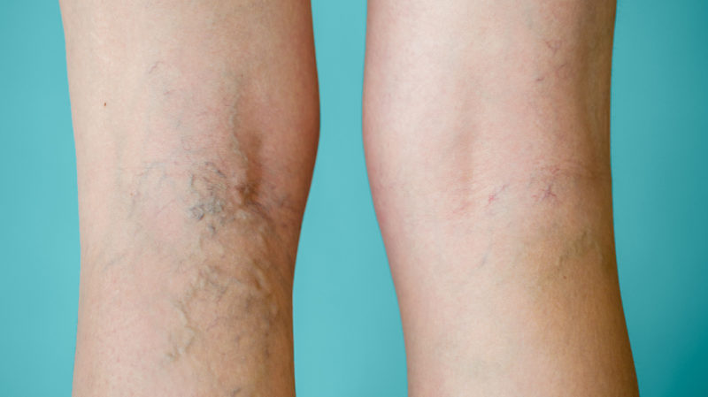 Venous Reflux Disease | Chronic Venous Insufficiency Stages | Venous ...