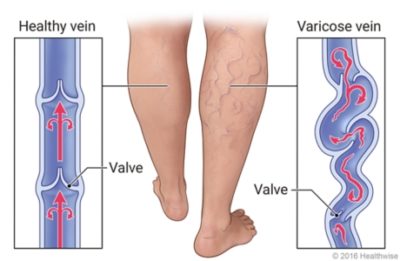 Venous Reflux Disease | Chronic Venous Insufficiency Stages | Venous insufficiency legs