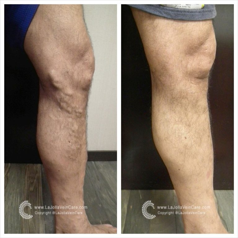 Ultrasound Findings of Normal vs. Diseased Great Saphenous Vein