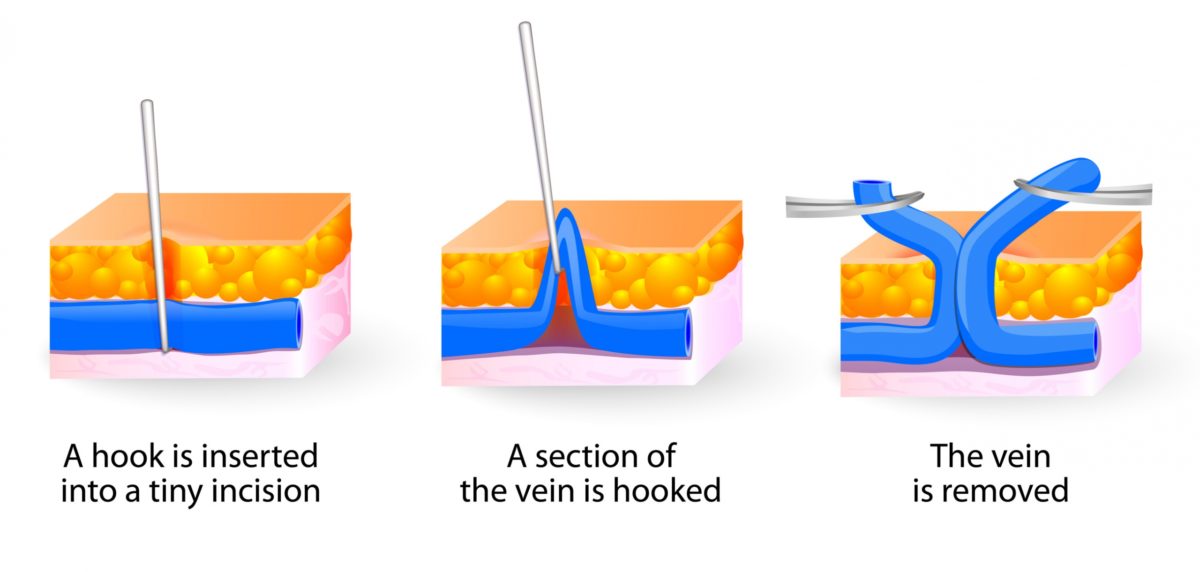 Expert Phlebectomy Procedures | La Jolla Vein & Vascular