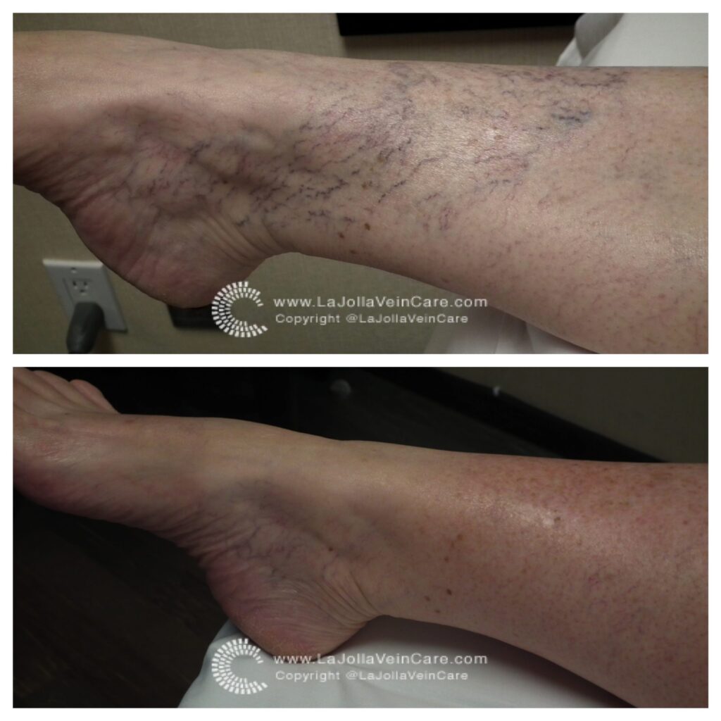 The Best Way To Treat Spider Veins