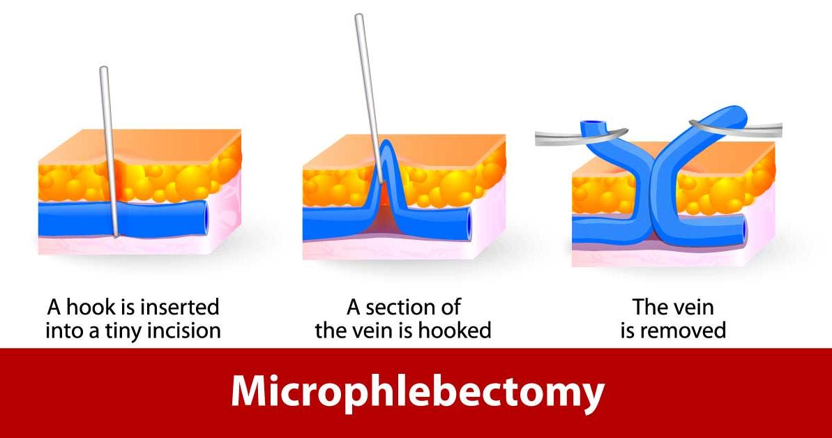 Phlebectomy