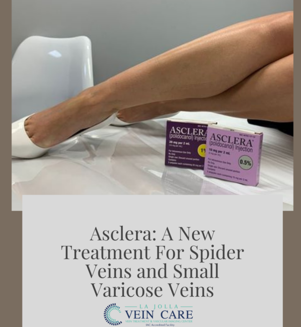 Asclera: A New Treatment For Spider Veins and Small Varicose Veins