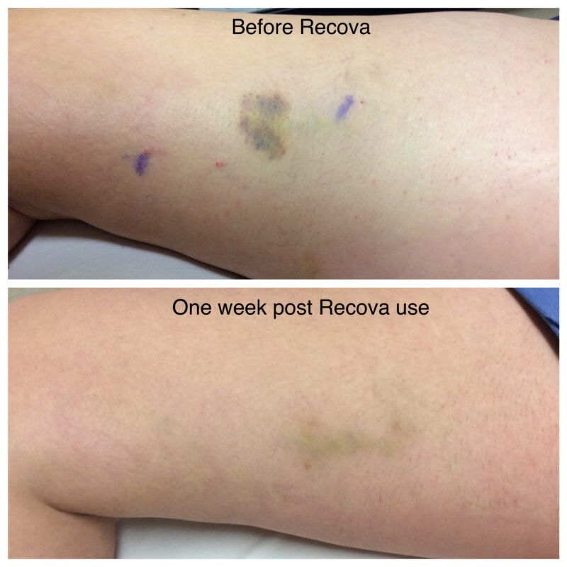 One Way to reduce bruising after surgery