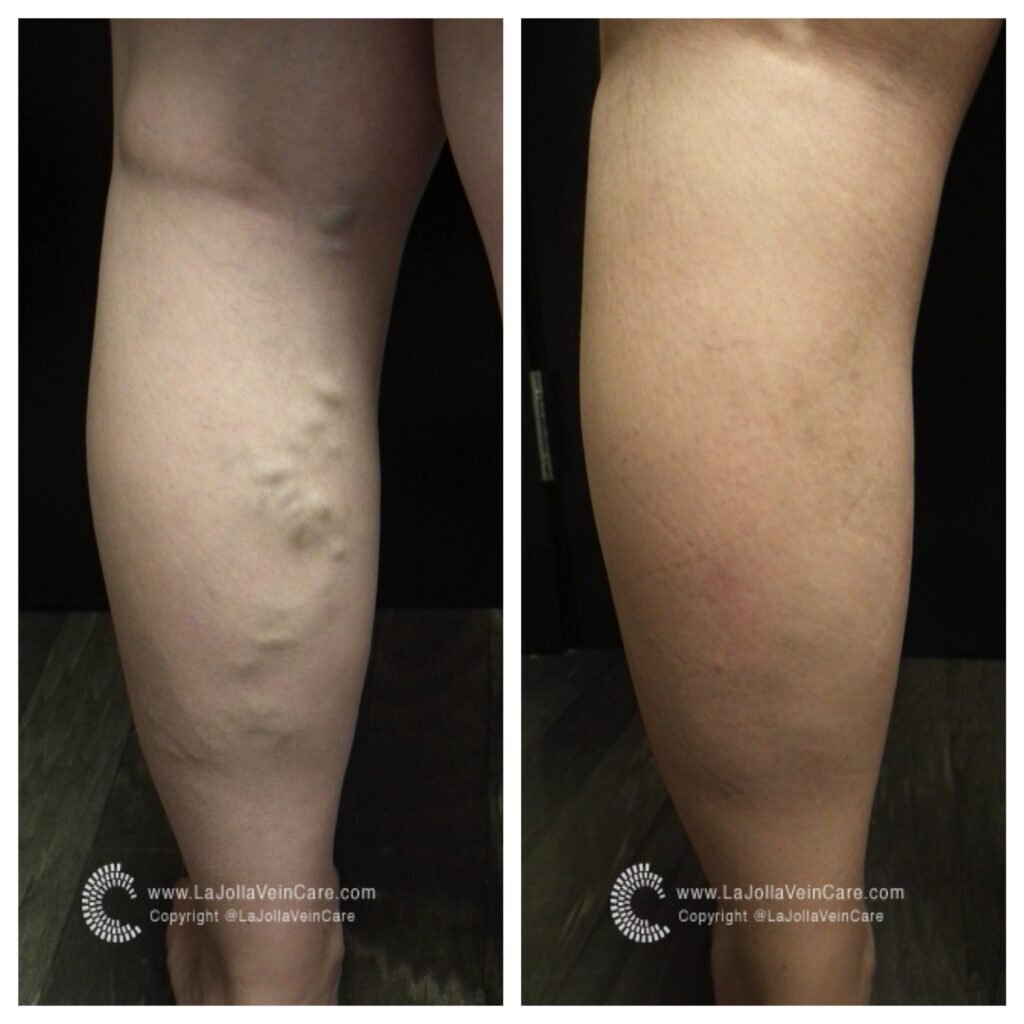 Varicose Veins: Patient Transformations Part 2
