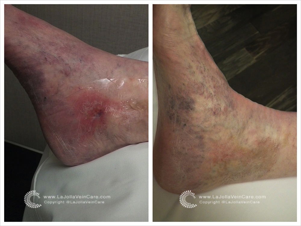 Chronic venous insufficiency and leg ulcers