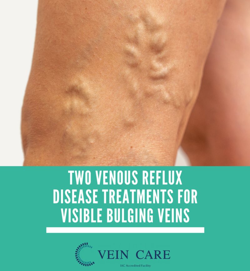 Two Venous Reflux Disease Treatments for visible bulging veins