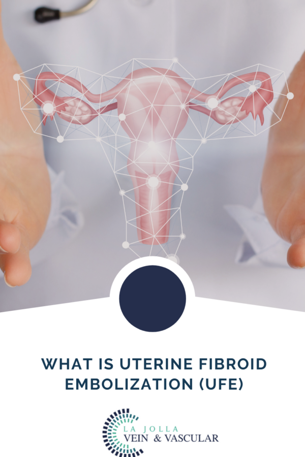 What is Uterine Fibroid Embolization (UFE)