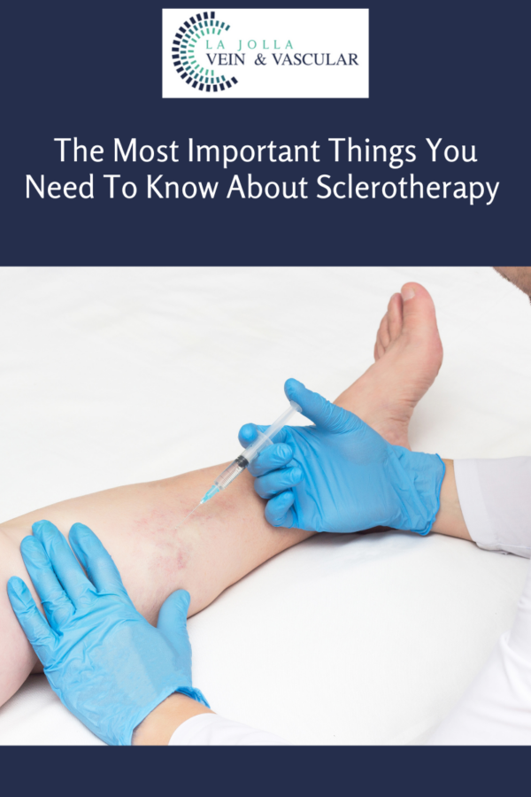 The most important things you need to know about sclerotherapy