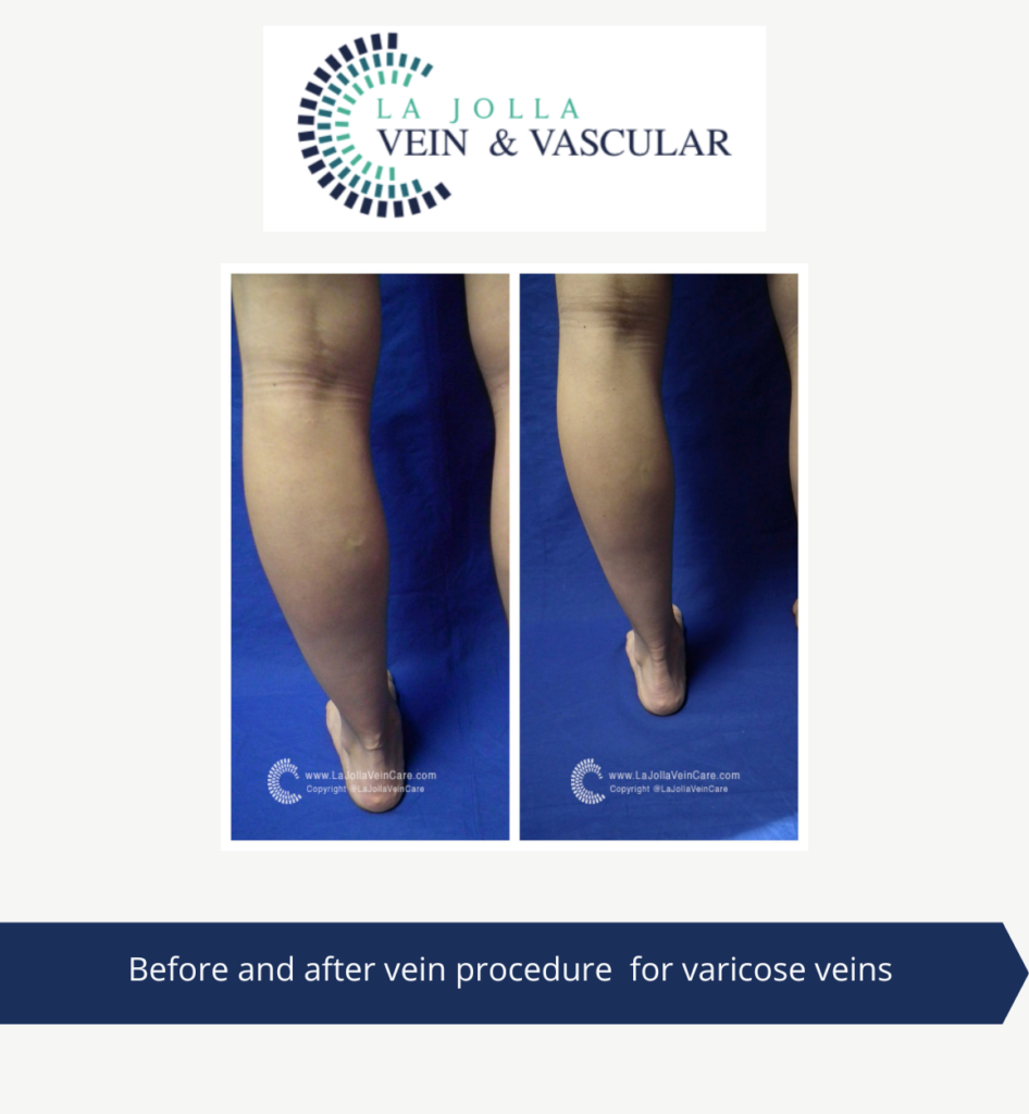 Vein & Vascular Treatment | Vein and Vascular Care Clinic | La Jolla, CA