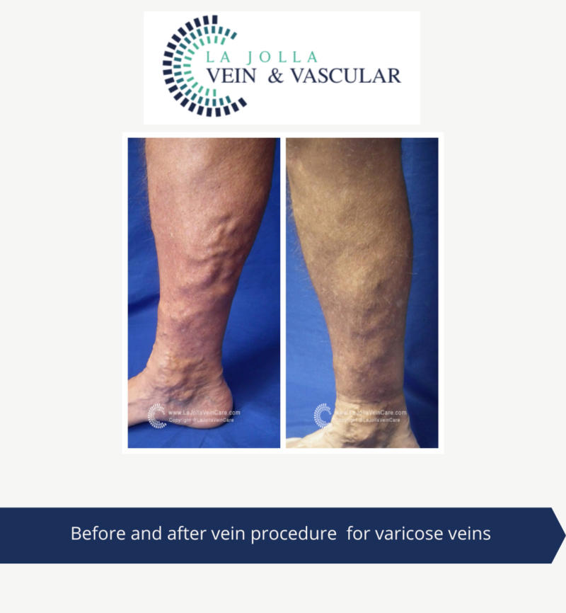 Vein & Vascular Treatment | Vein and Vascular Care Clinic | La Jolla, CA
