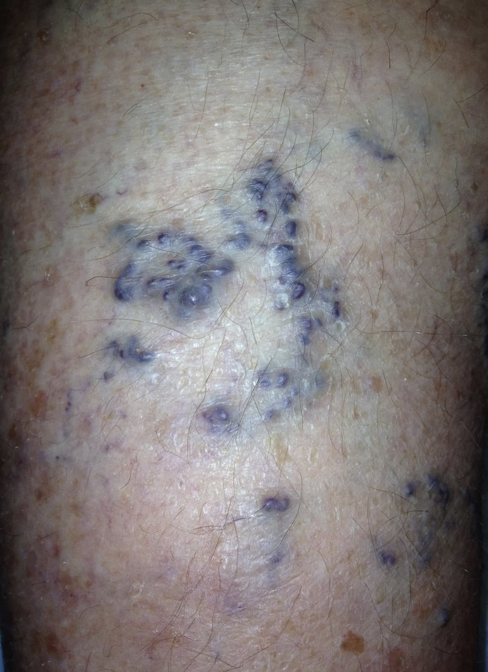 Vein & Vascular Treatment | Vein and Vascular Care Clinic | La Jolla, CA