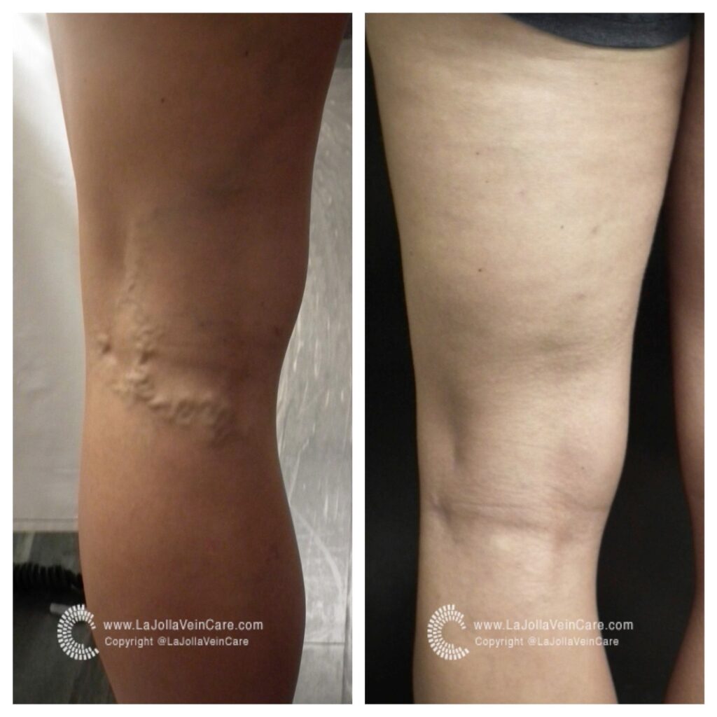 Vein & Vascular Treatment