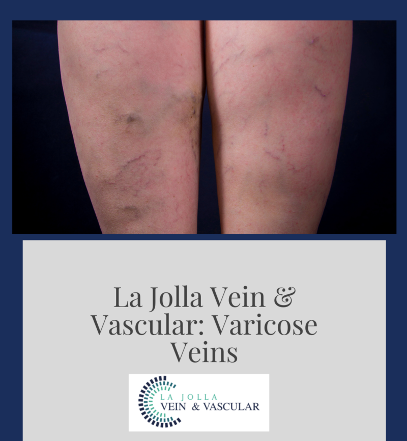 Varicose veins Vein & Vascular Treatment