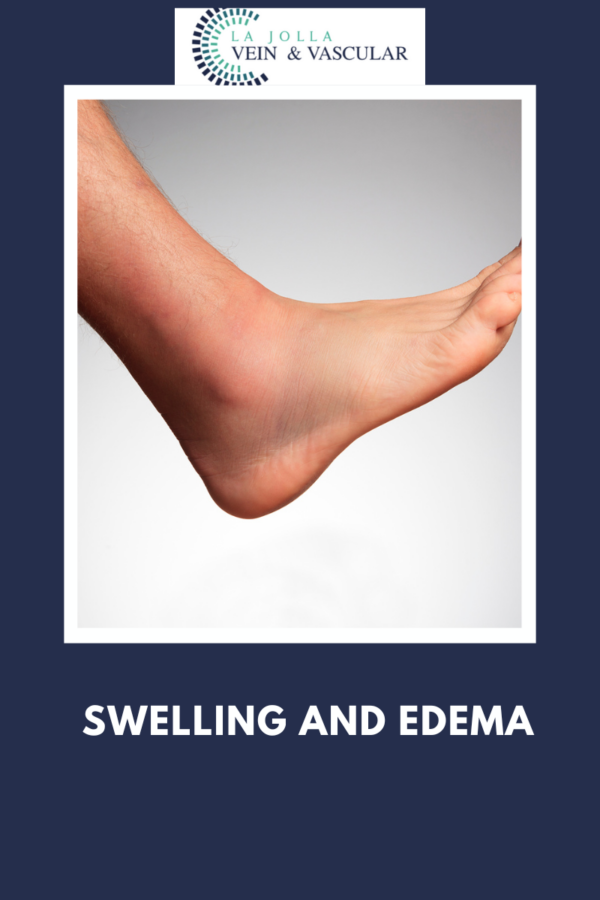Vein & Vascular Treatment | Swelling & Edema