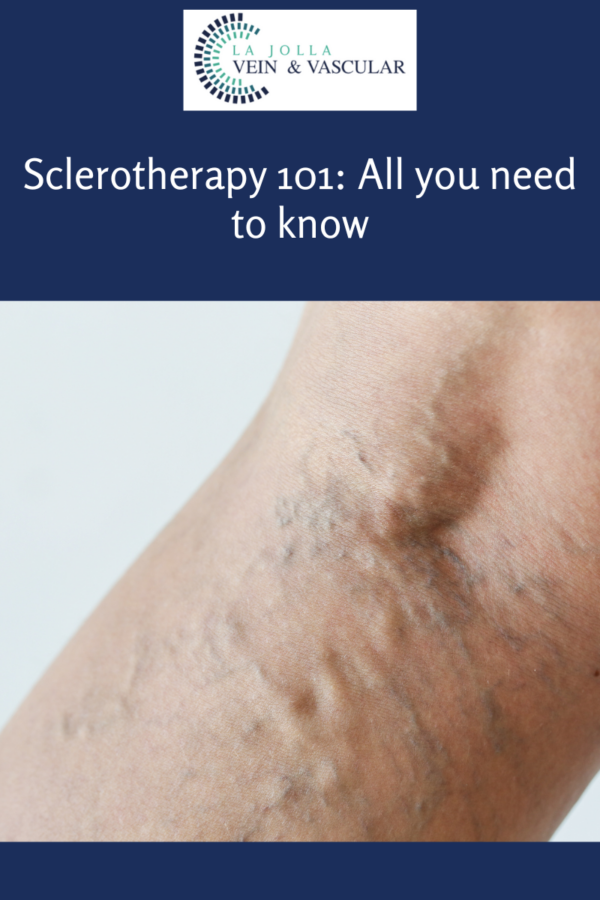 Vein & Vascular Treatment | Sclerotherapy 101