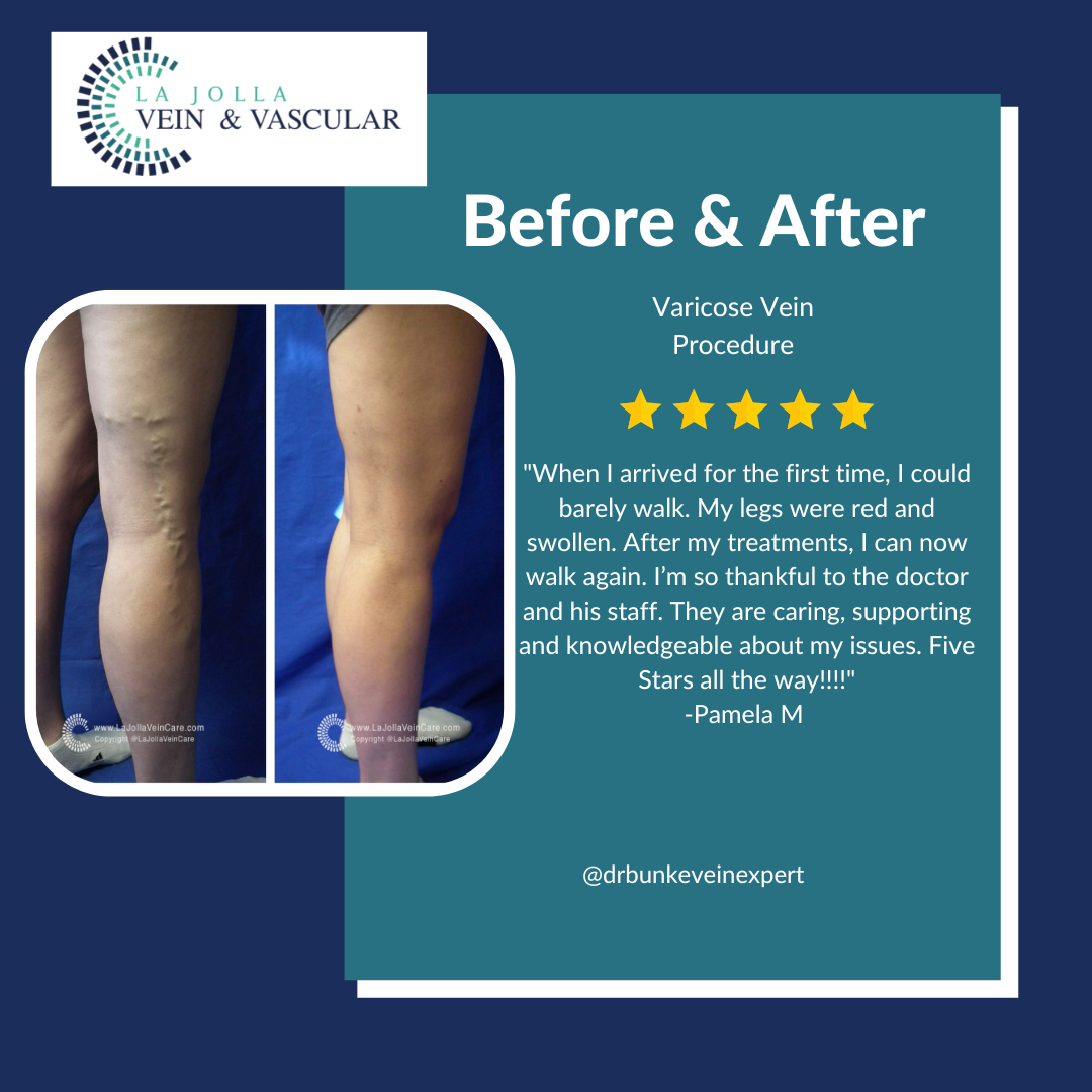 Vein & Vascular Treatment | Patient Testimonials