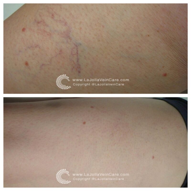 Spider Vein & Vascular Treatment