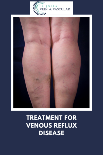 Vein & Vascular Treatment | Venous Reflux