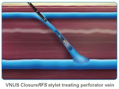 Vein & Vascular Treatment | Perforator Vein