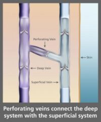 Vein & Vascular Treatment | Perforator Vein