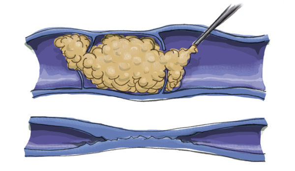 Vein And Vascular Treatment Varithena