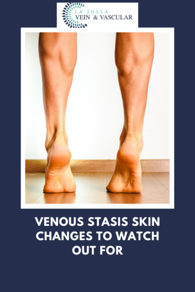 Vein & Vascular Treatment | Venous Stasis