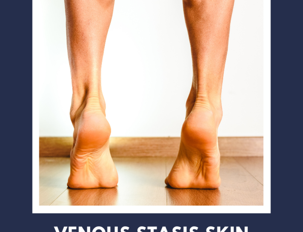 Venous Reflux Disease | Chronic Venous Insufficiency Stages | Venous ...