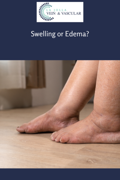 Vein & Vascular Treatment | Swelling or Edema?