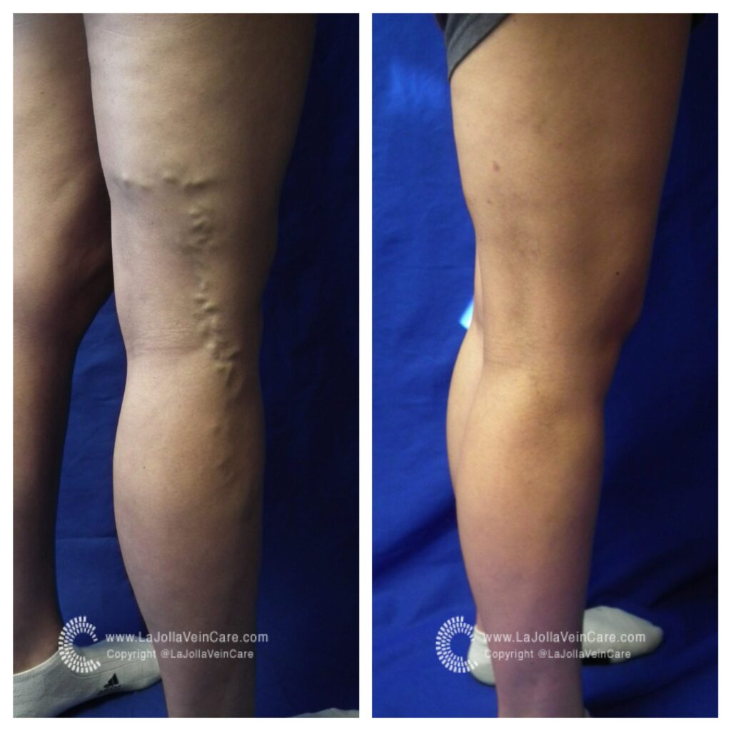 Varicose Vein Treatment Before and After