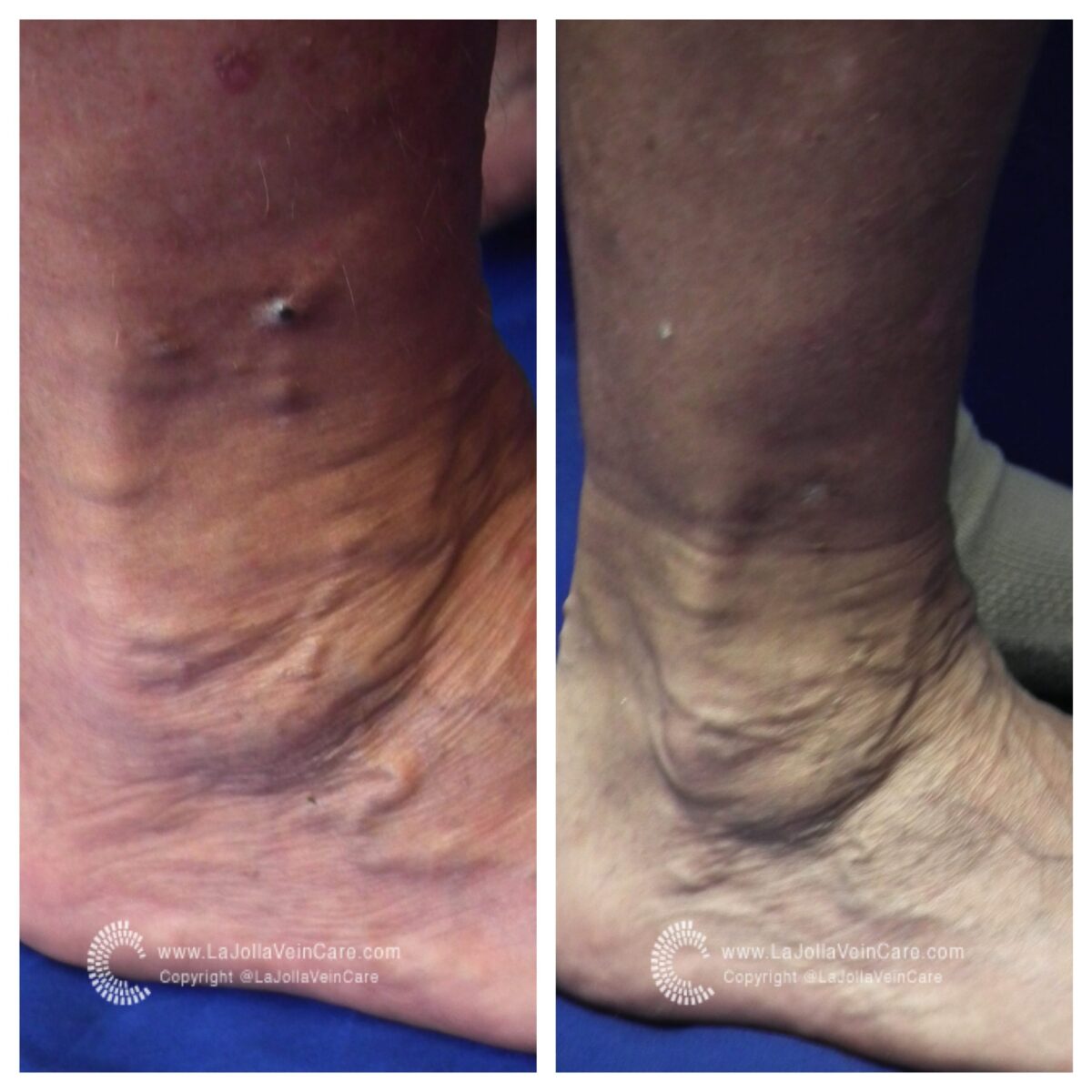 Varicose Vein Treatment Before and After