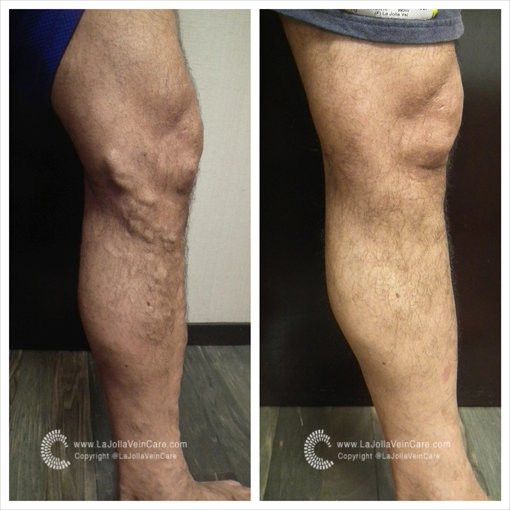 Varicose Vein Treatment Before and After