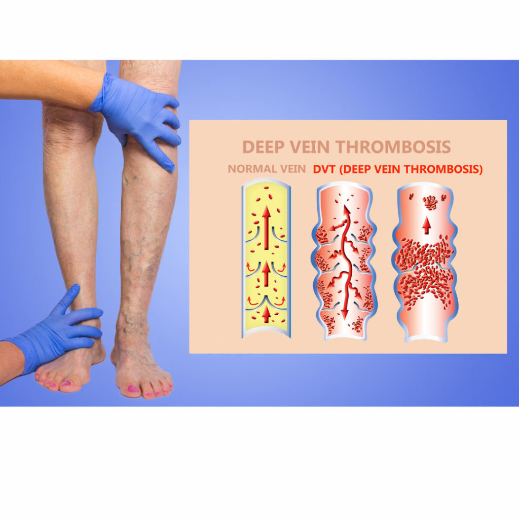Vein & Vascular Treatment | Deep Vein Thrombosis