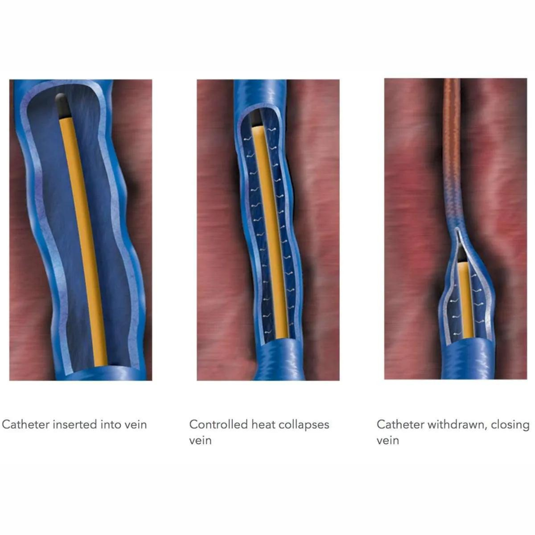 Vein & Vascular Treatment | ClosureFast