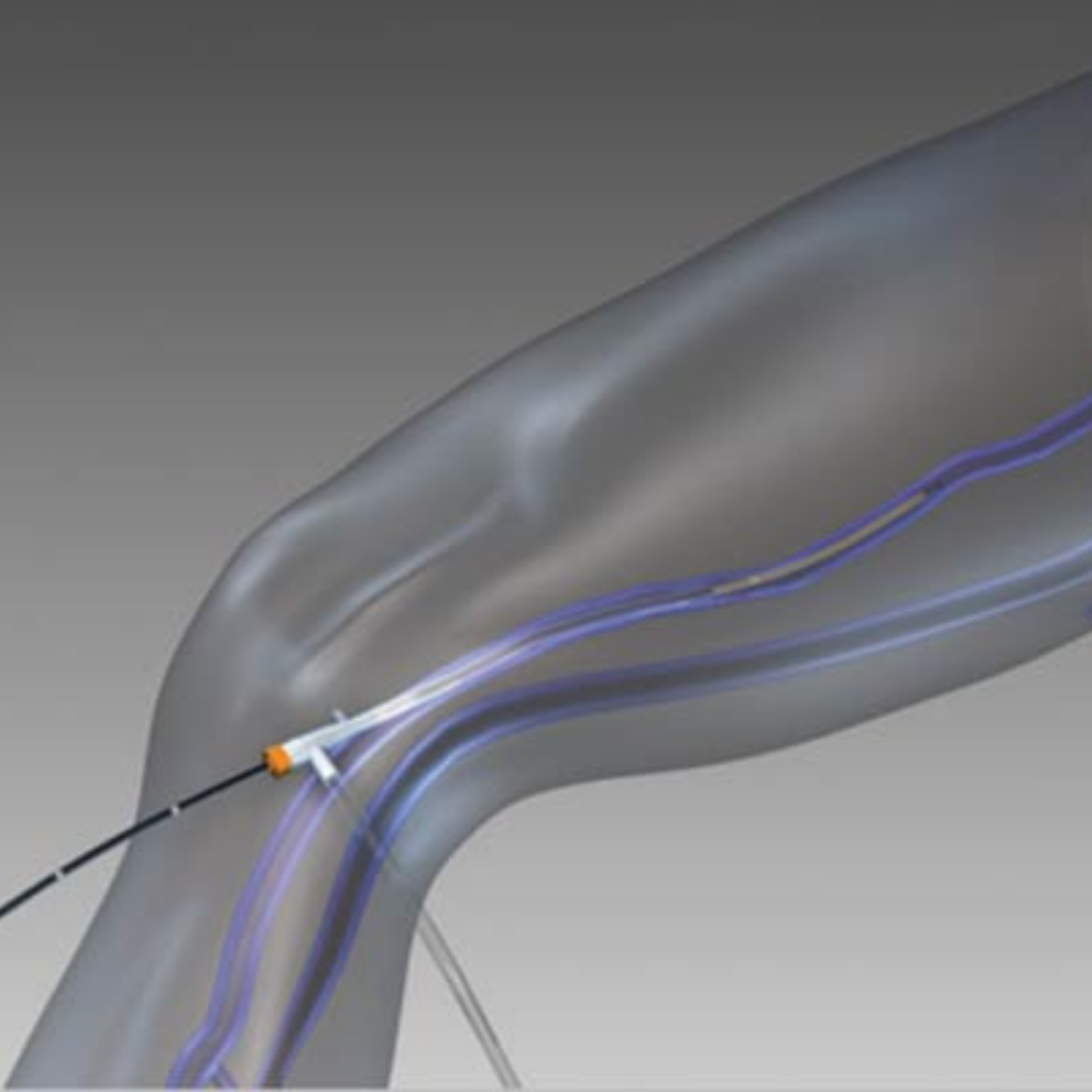 Vein & Vascular Treatment | ClosureFast