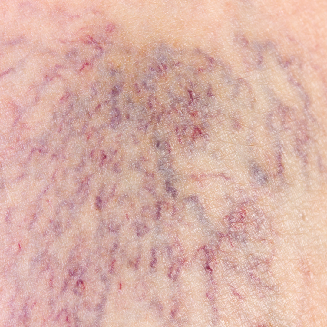 Vein & Vascular Treatment | Vein Disease