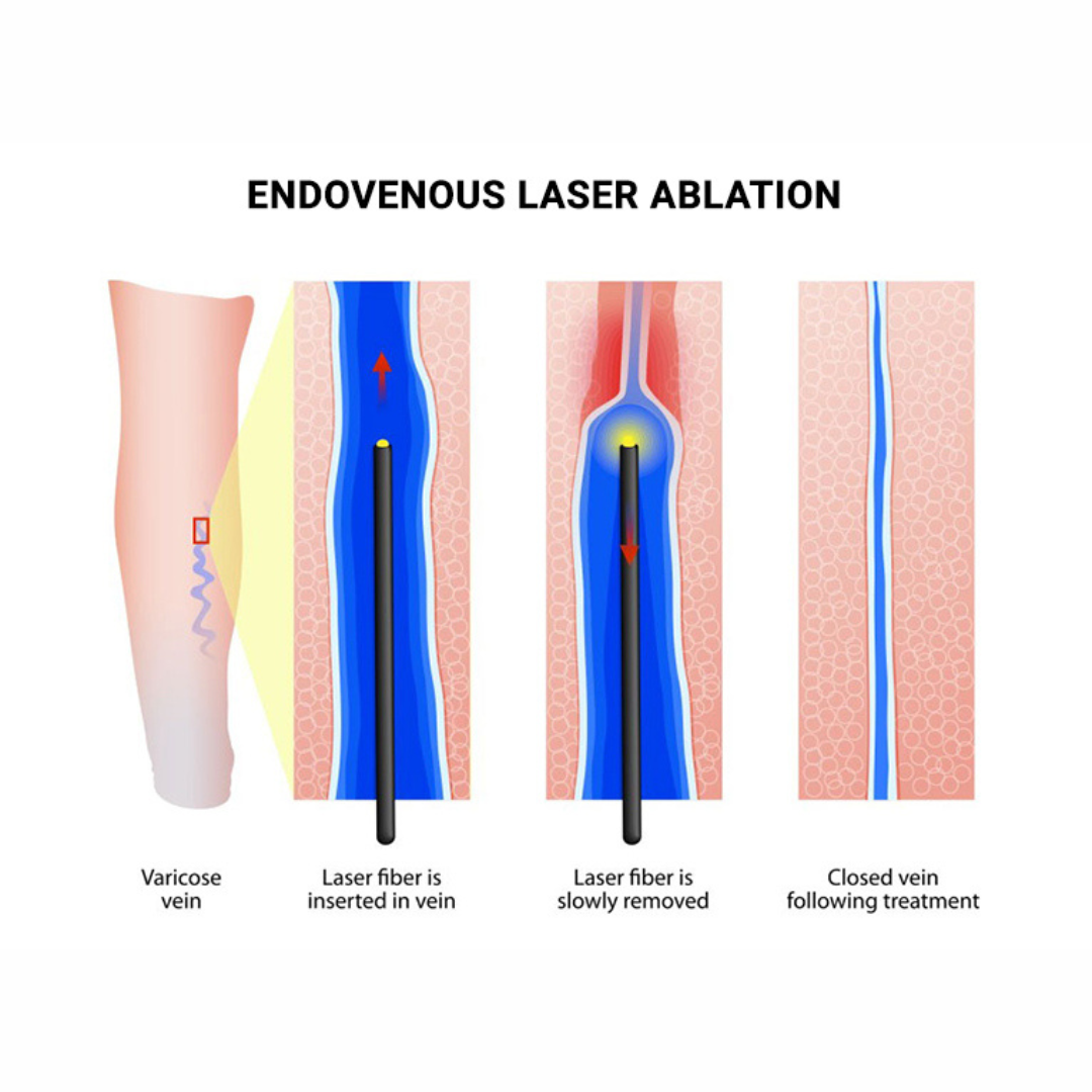 Vein & Vascular Treatment | Laser Ablation