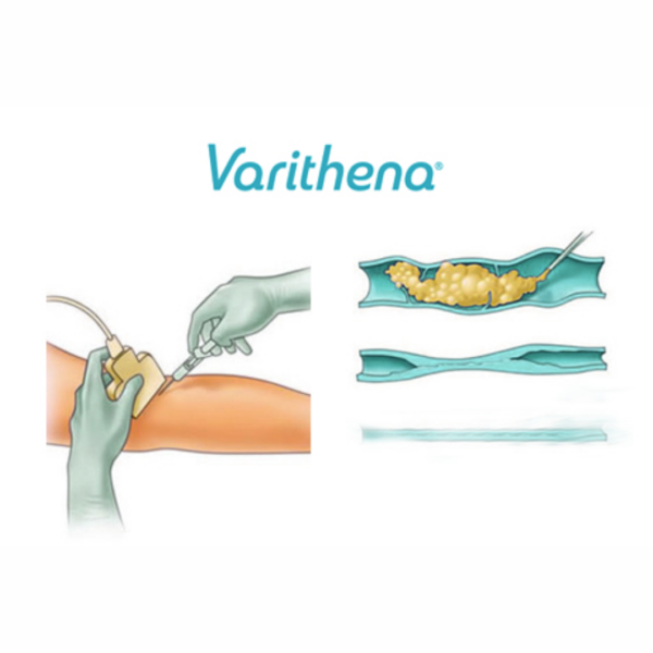 Vein And Vascular Treatment Chemical Ablation