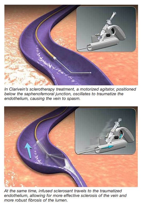 ClariVein Treatment: Minimally Invasive Solution for Leg Vein Health
