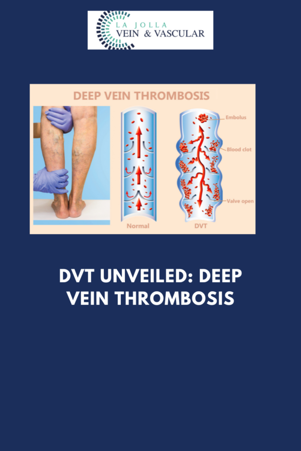 Flying after vein treatment
