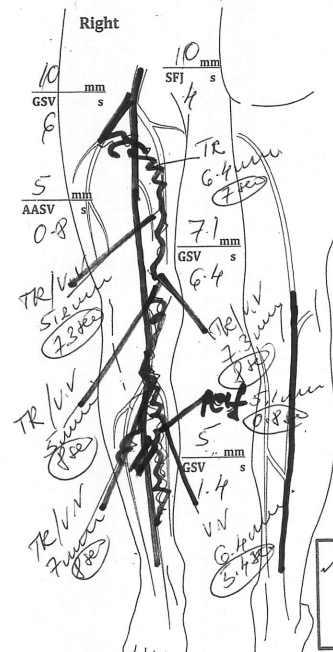 Vein Mapping Ultrasound | Vein Mapping in Vascular Health