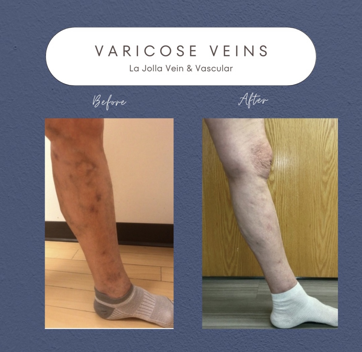 Vein Mapping Ultrasound | Vein Mapping in Vascular Health