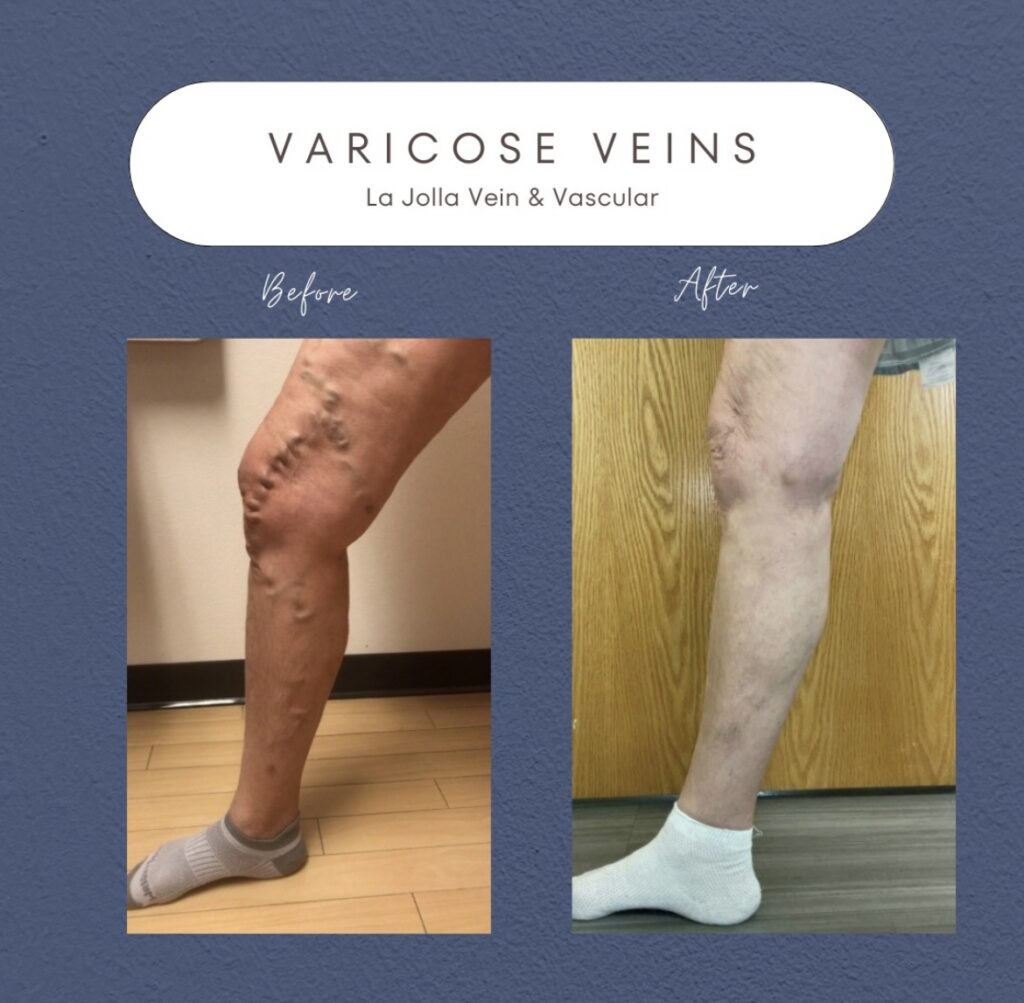 Vein Mapping Ultrasound | Vein Mapping in Vascular Health