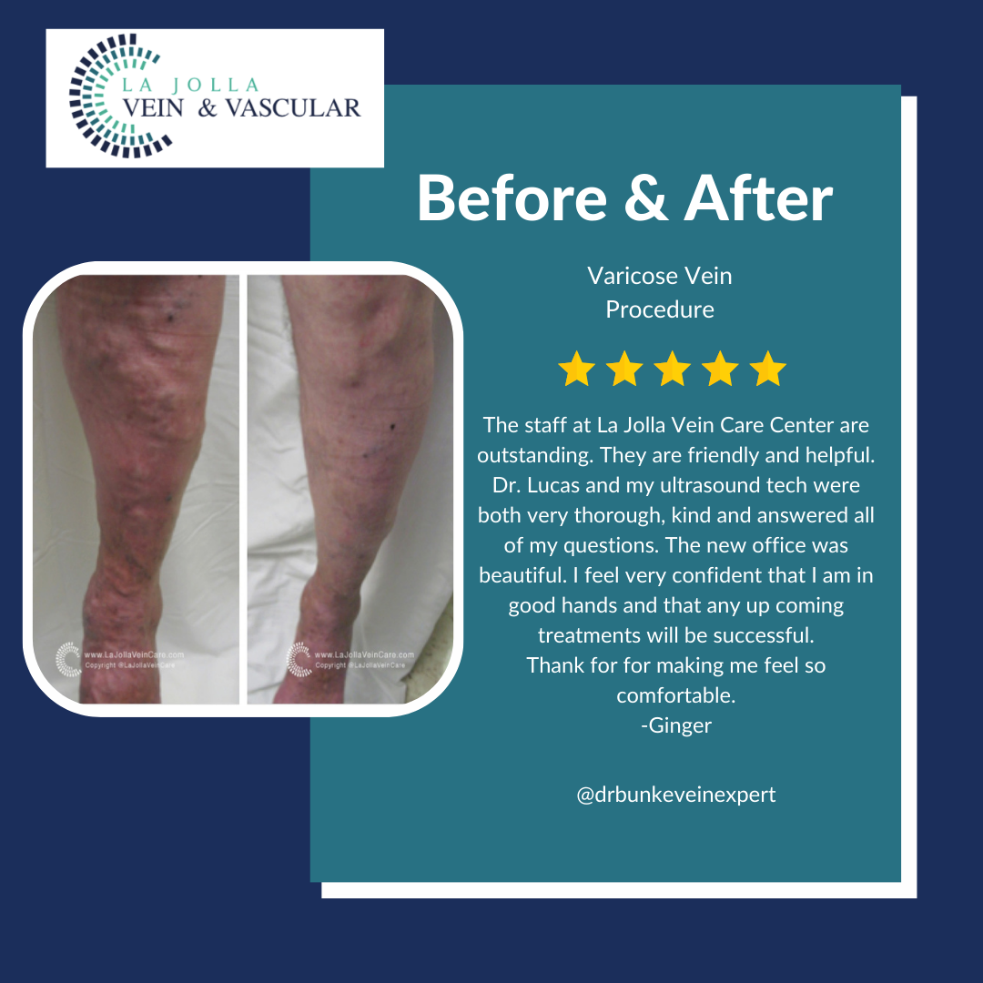 Patient Testimonials | La Jolla Vein & Vascular Clinic