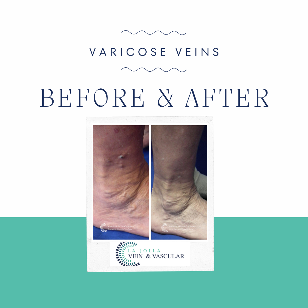 Legs Look Like After Varicose Vein Removal | Vein Removal Legs