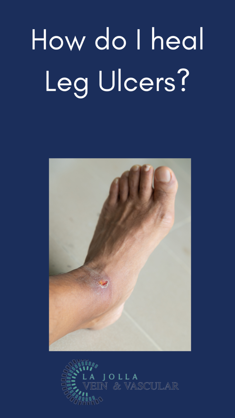 Healing Leg Ulcers: Treatment Options & Prevention Tips