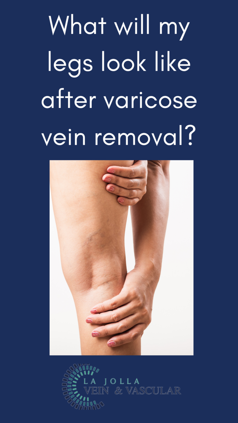 Legs Look Like After Varicose Vein Removal | Vein Removal Legs