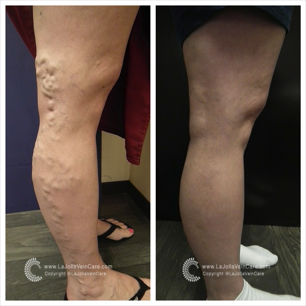 Varicose Vein Transformations of Our Patients - La Jolla Vein & Vascular